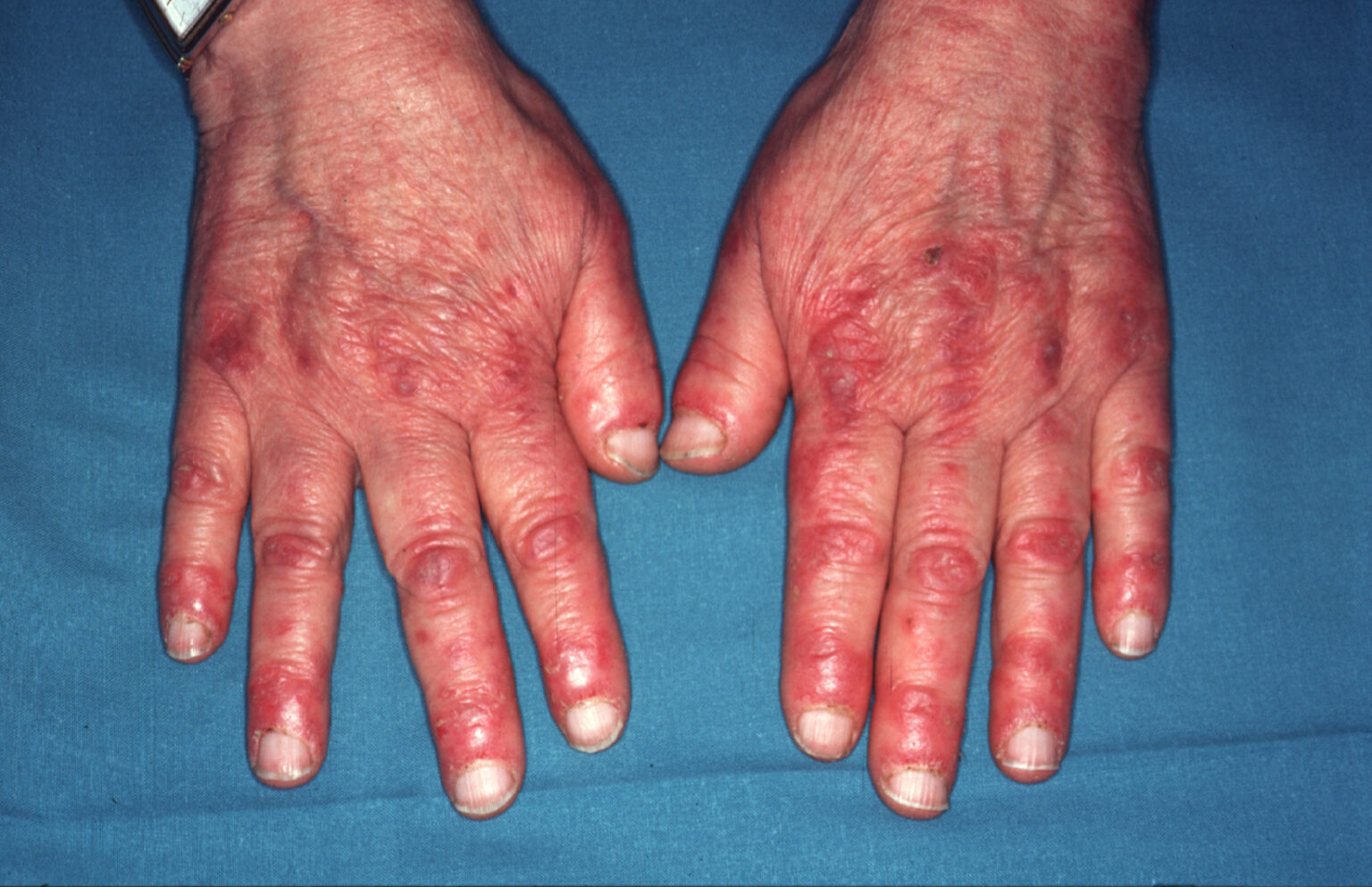 Dermatomiositis: enfermedad inflamatoria que afecta piel y músculos